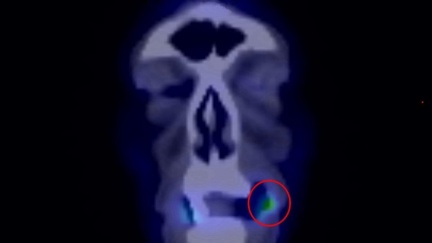 台中11歲女童大叫後猝死 驗出「B19病毒」蘋果病引發心肌炎│TVBS新聞網