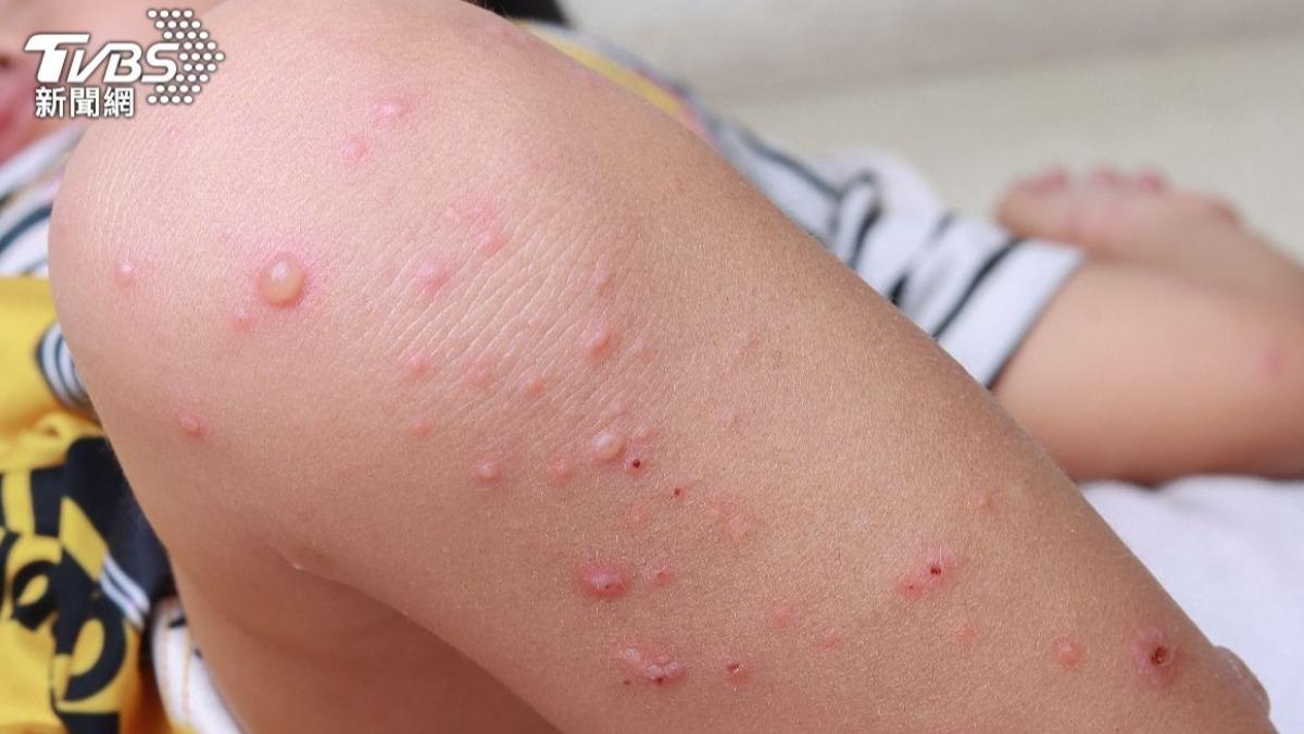 腸病毒還在流行 最小重症「僅出生4天男嬰」併發肝炎住ICU│TVBS新聞網