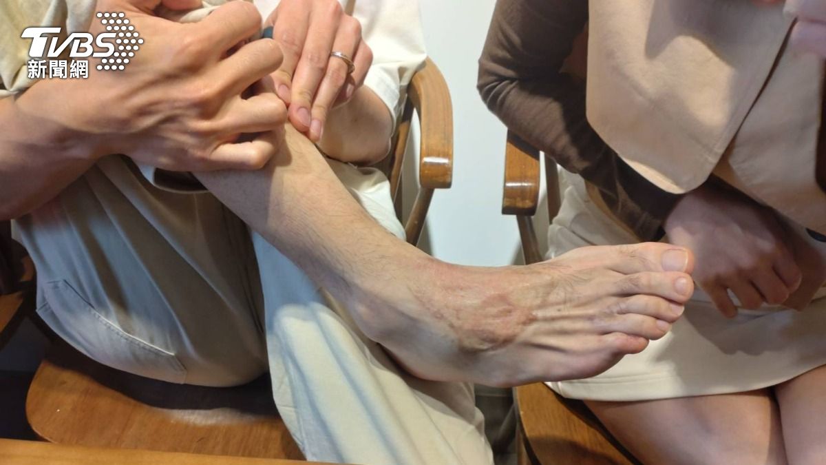 八點檔男星驚遇死亡車禍「腳掌全變形」 截肢殘缺照曝光│TVBS新聞網