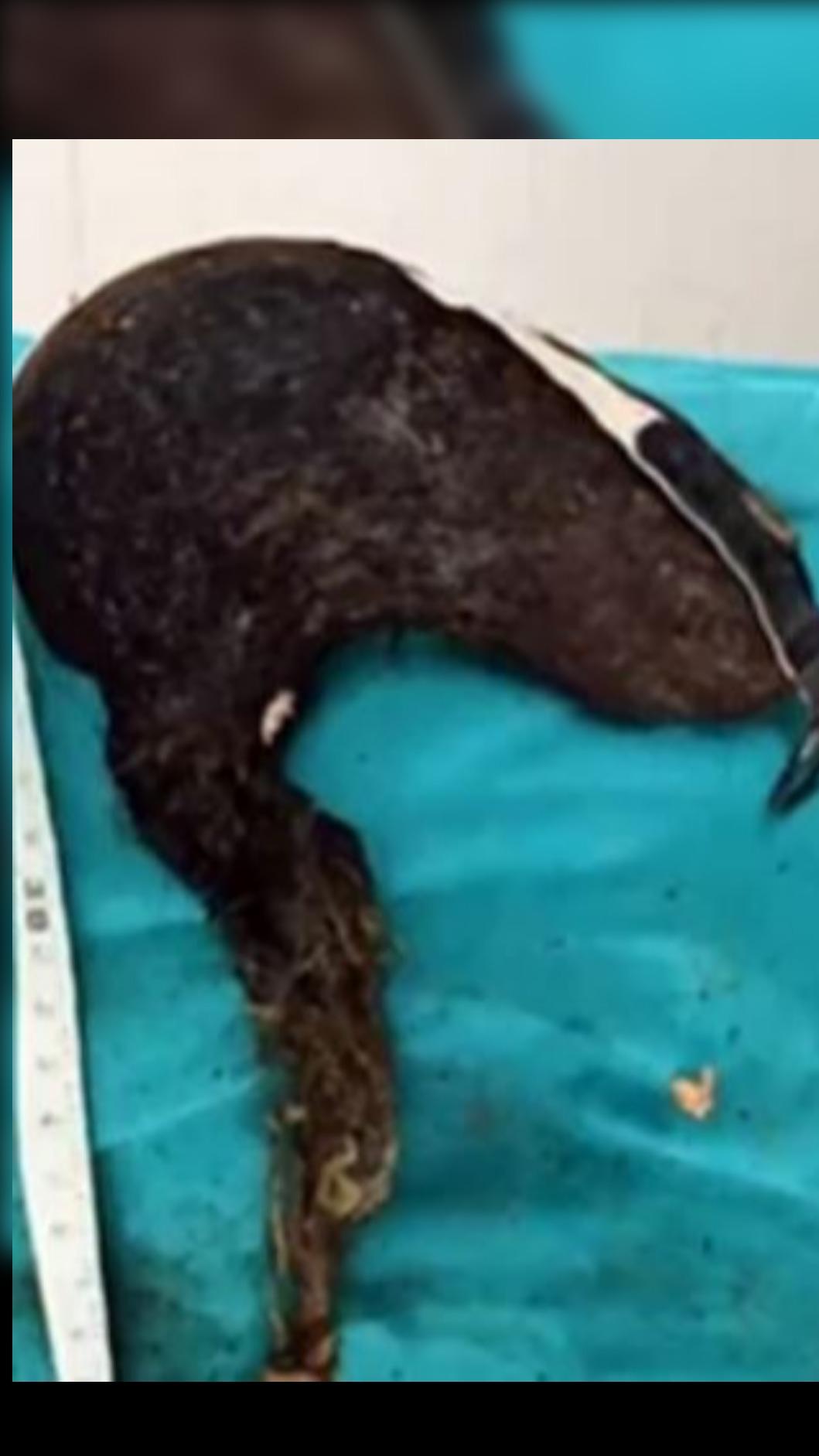 14歲少女腹痛送醫 醫從胃中取出「210公分毛髮結石」│TVBS新聞網