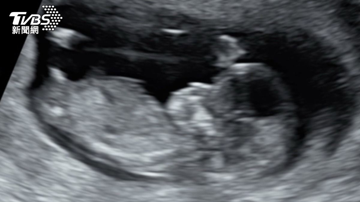 高齡產婦勇敢追夢！她打上百針換來一個孩子 關鍵是「這件事」│TVBS新聞網