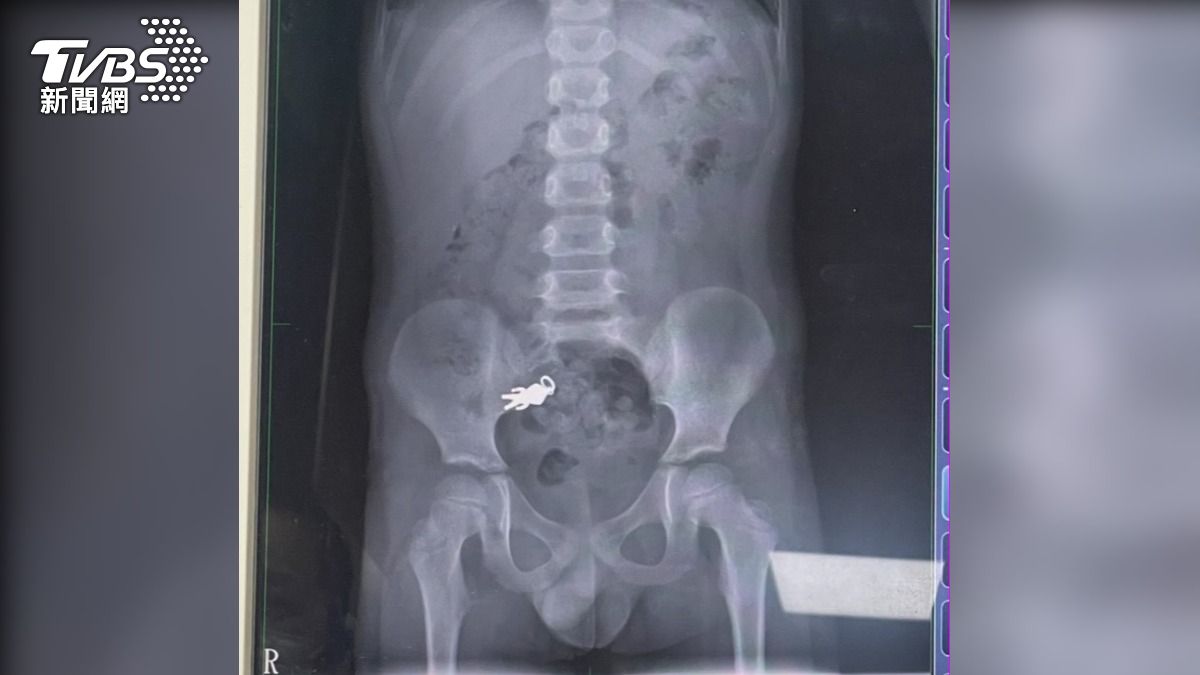 想變身？8歲童吃餅乾配電視 誤吞2cm「超人力霸王」│TVBS新聞網