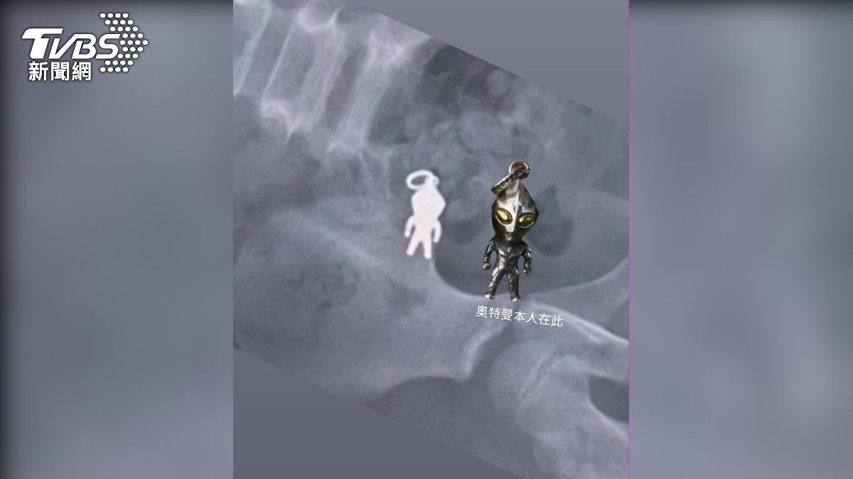 想變身？8歲童吃餅乾配電視 誤吞2cm「超人力霸王」│TVBS新聞網