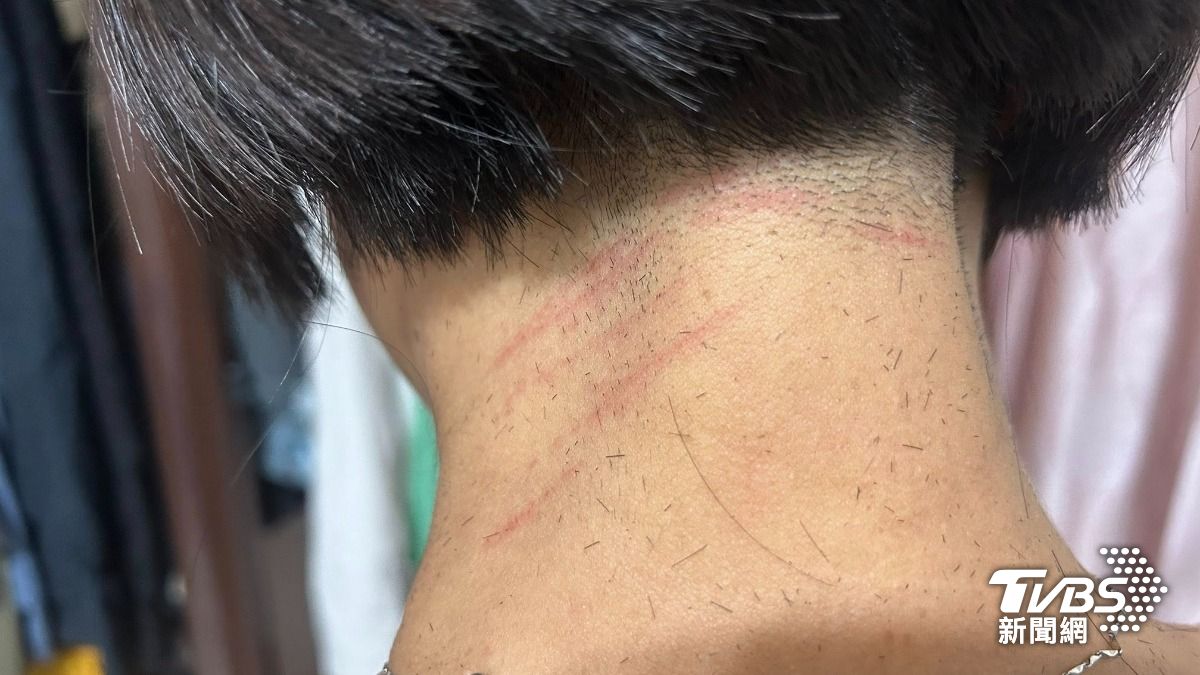 10分鐘快剪釀慘案？ 女後頸「8道紅痕」嚇壞老公│TVBS新聞網