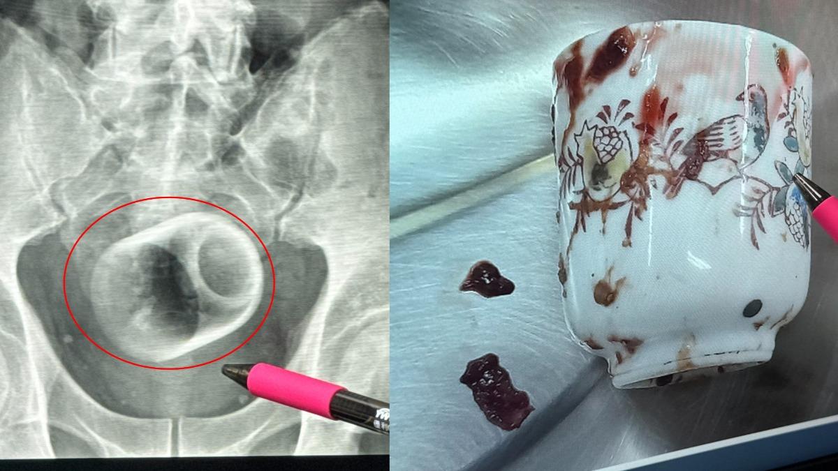 6*8水杯塞肛門…台中男腸壞死無法排便 醫：還有人拿椰子│TVBS新聞網