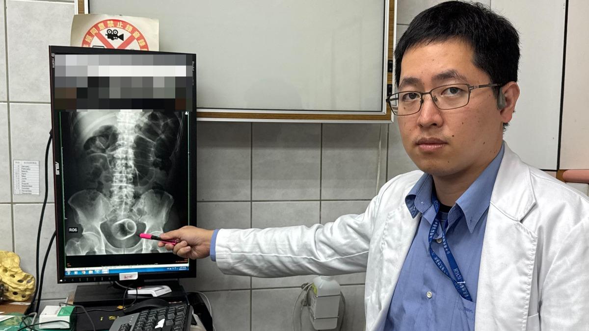 6*8水杯塞肛門…台中男腸壞死無法排便 醫：還有人拿椰子│TVBS新聞網