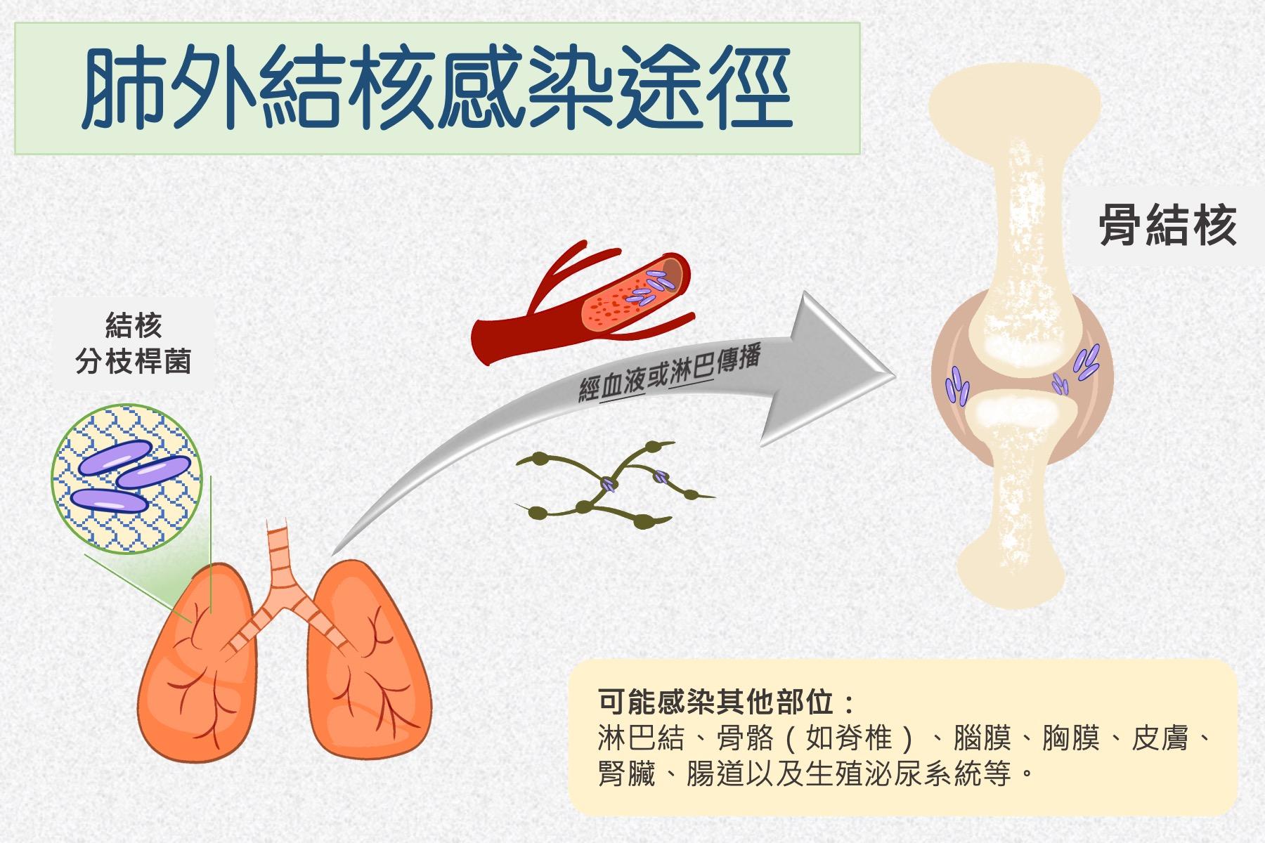 腳腫痛無法彎！台中翁遭細菌「啃骨化膿」走不了 5徵兆注意│TVBS新聞網