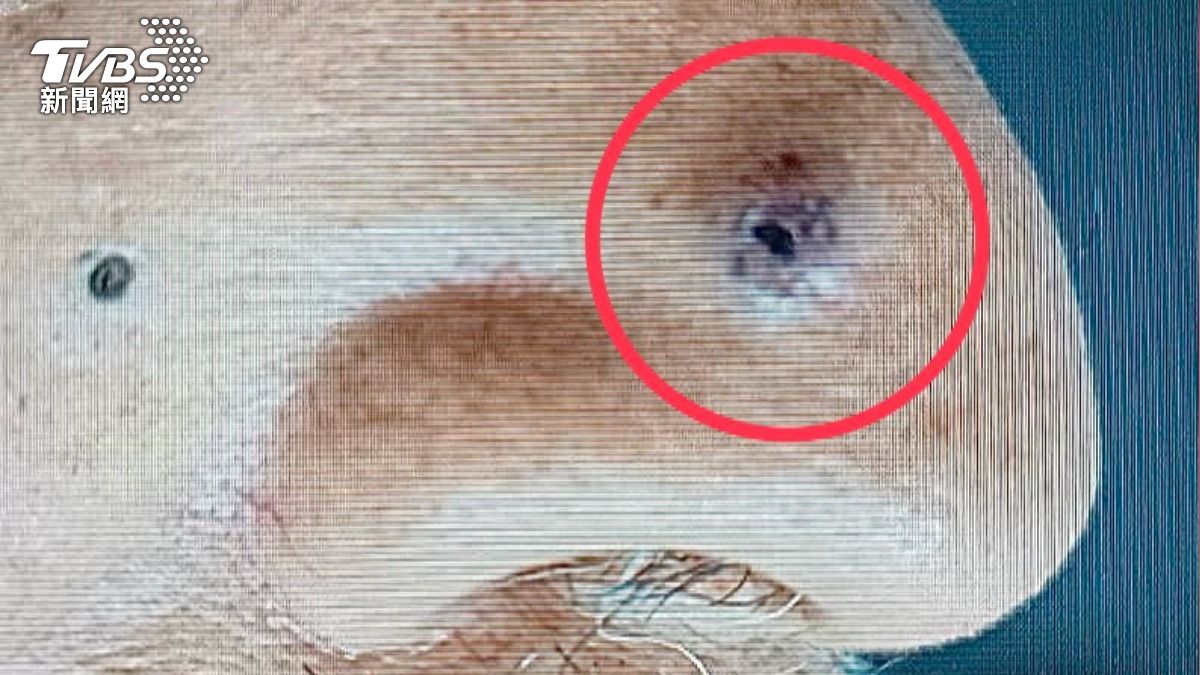 鼻頭一顆小黑痣放2年加深噴血 台中男一查竟罹皮膚癌│TVBS新聞網